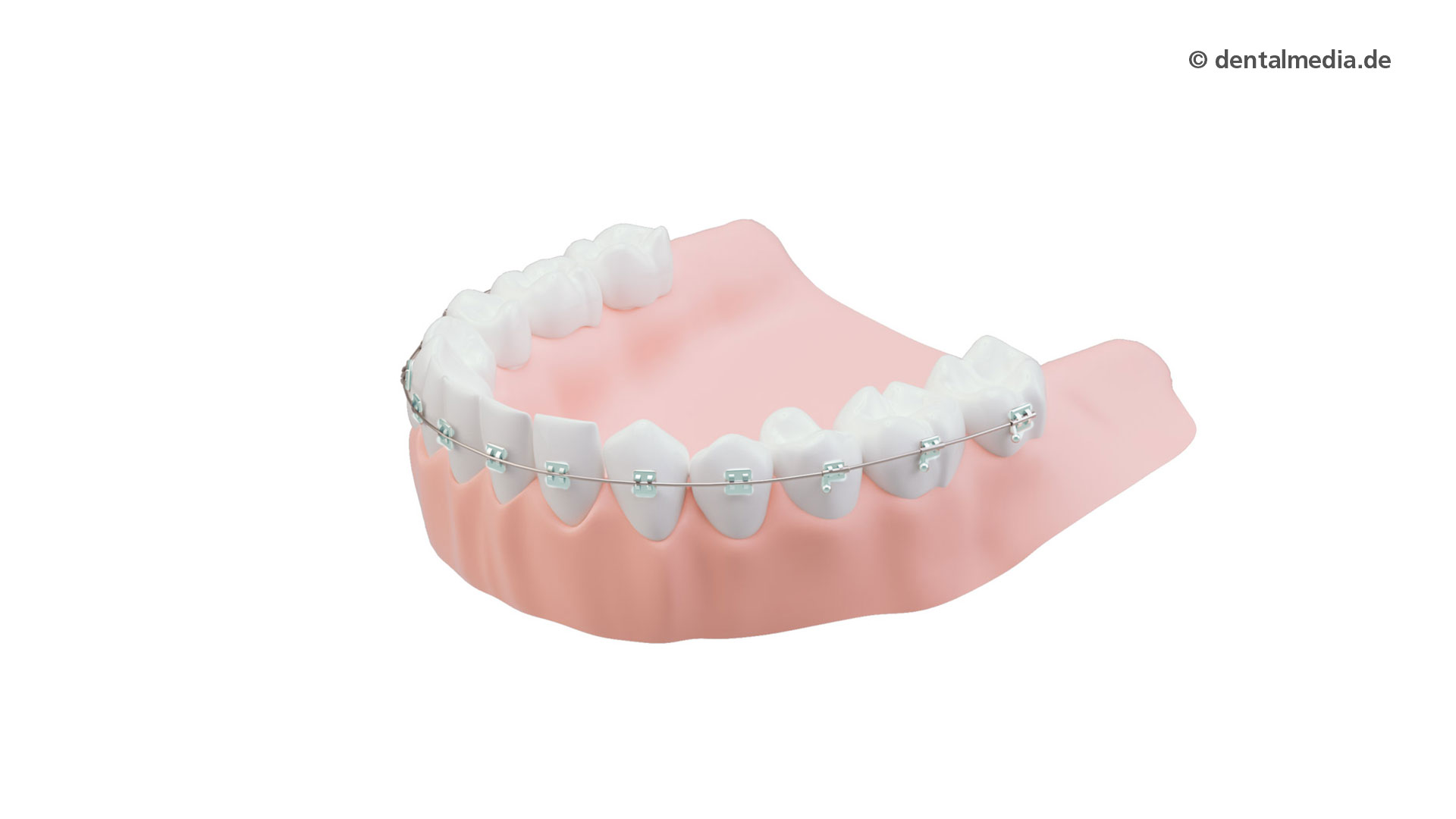 Keramikbrackets — KFO Forster in Burglengenfeld